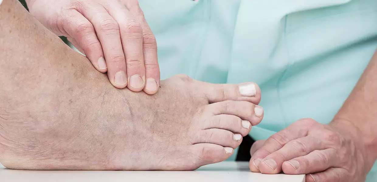 Come scegliere il miglior centro per l'intervento all’alluce valgo