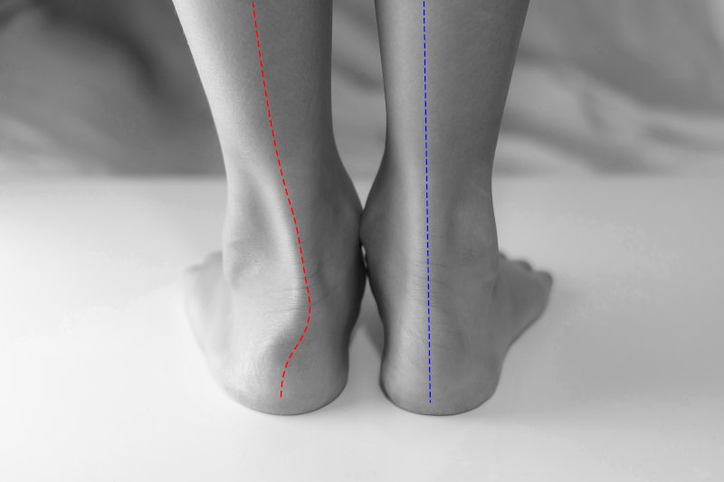 Piede Piatto: sintomi, diagnosi e terapia