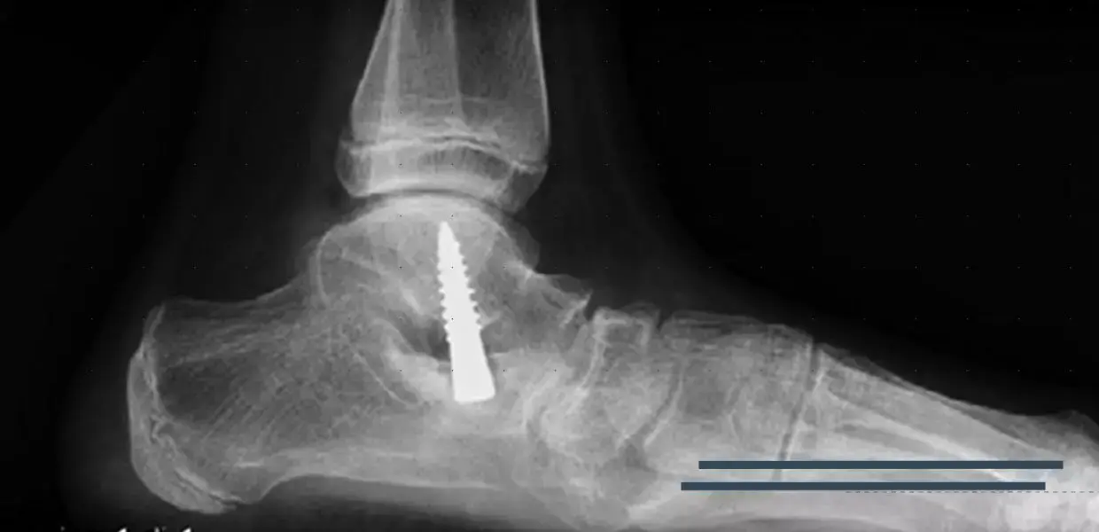 The Calcaneo-stop procedure: a minimally invasive procedure